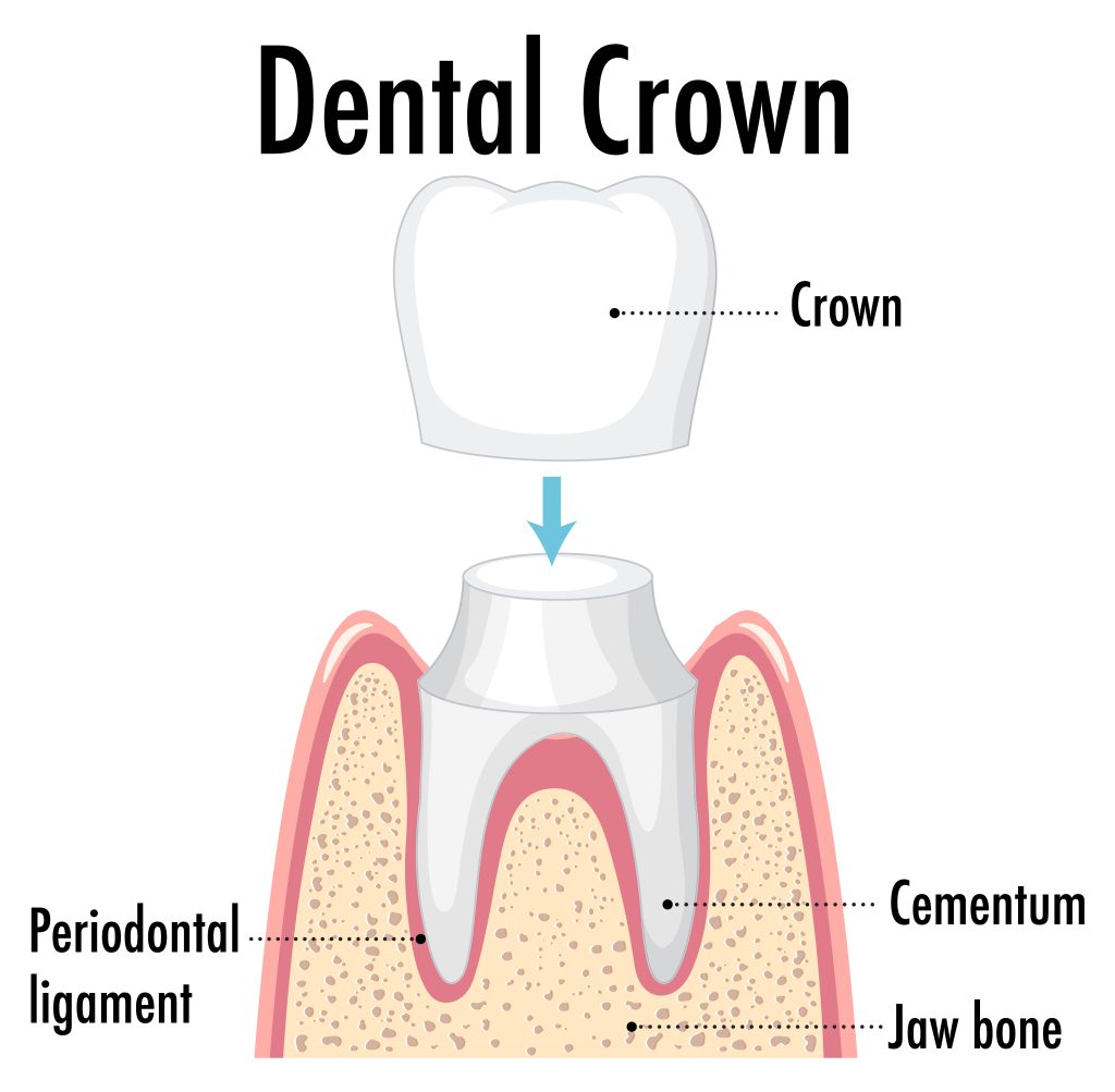 Coronas Dentales En Houston, TX - Best Dental