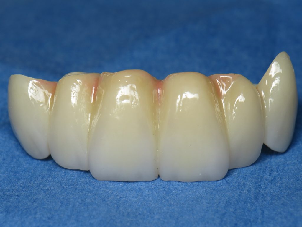 6 Unit Canine To Canine Bridge Cost - Best Dental