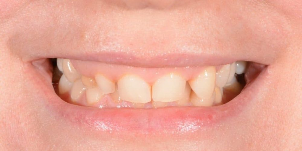 Why Are My Teeth So Small? - Best Dental