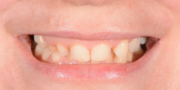 Why Are My Teeth So Small? - Best Dental