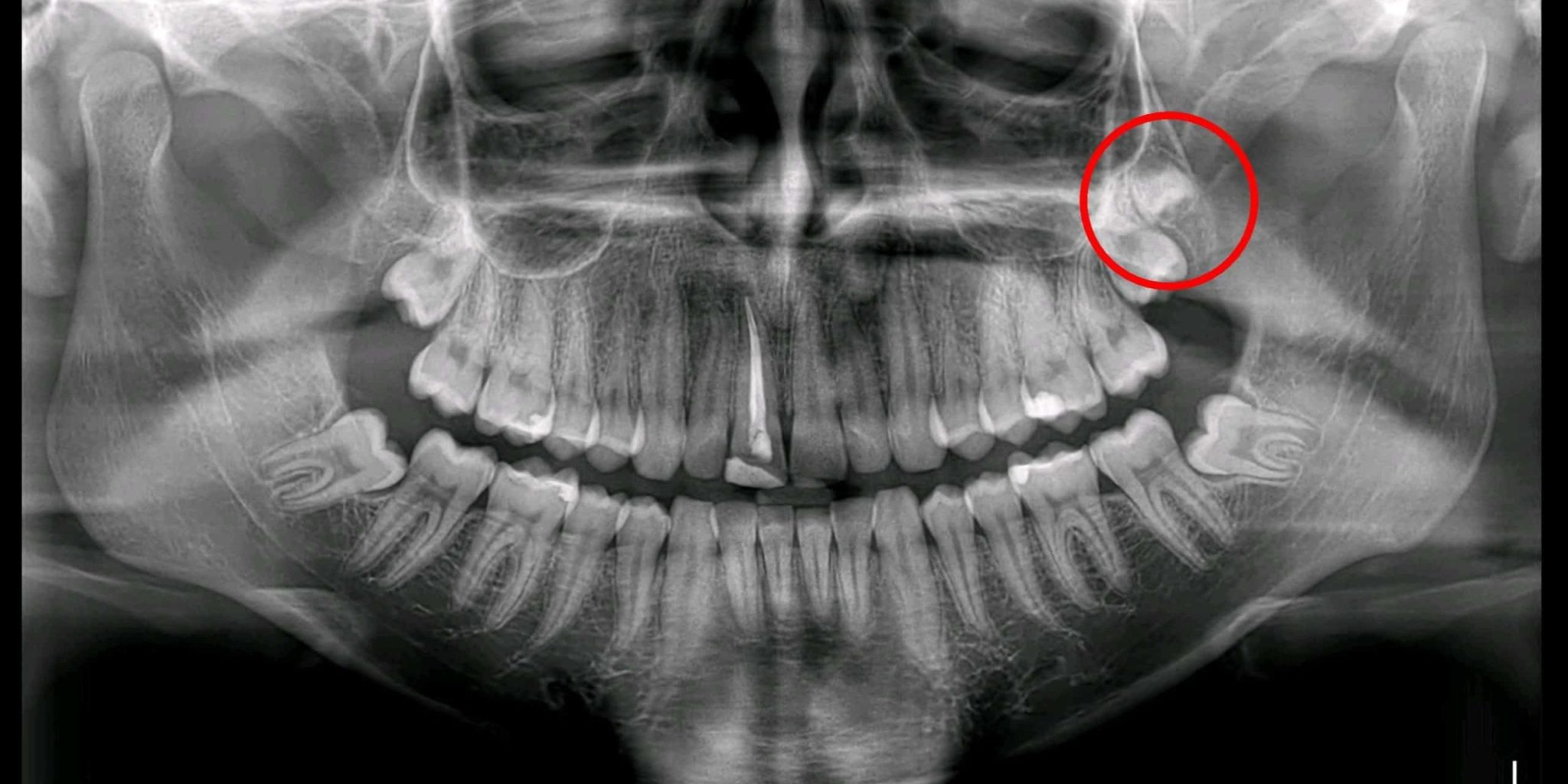 Supernumerary Wisdom Teeth - A Comprehensive Guide - Best Dental