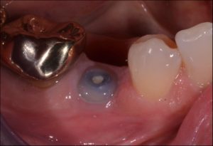 What Are Dental Implant Healing Caps? - Best Dental