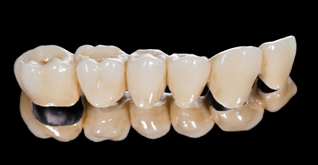 Front Dental Bridges - A Complete Guide - Best Dental
