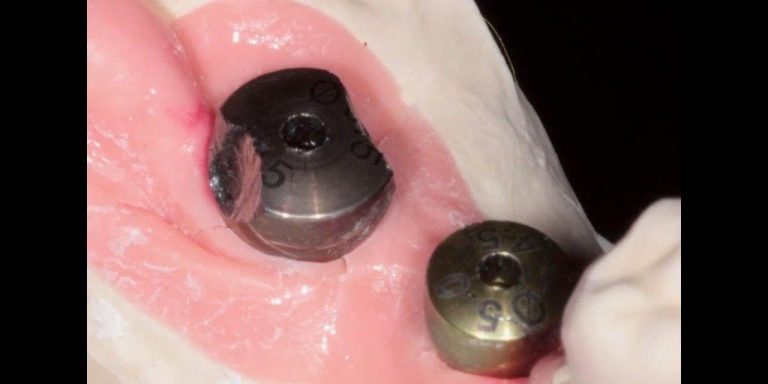 What Are Dental Implant Healing Caps? - Best Dental