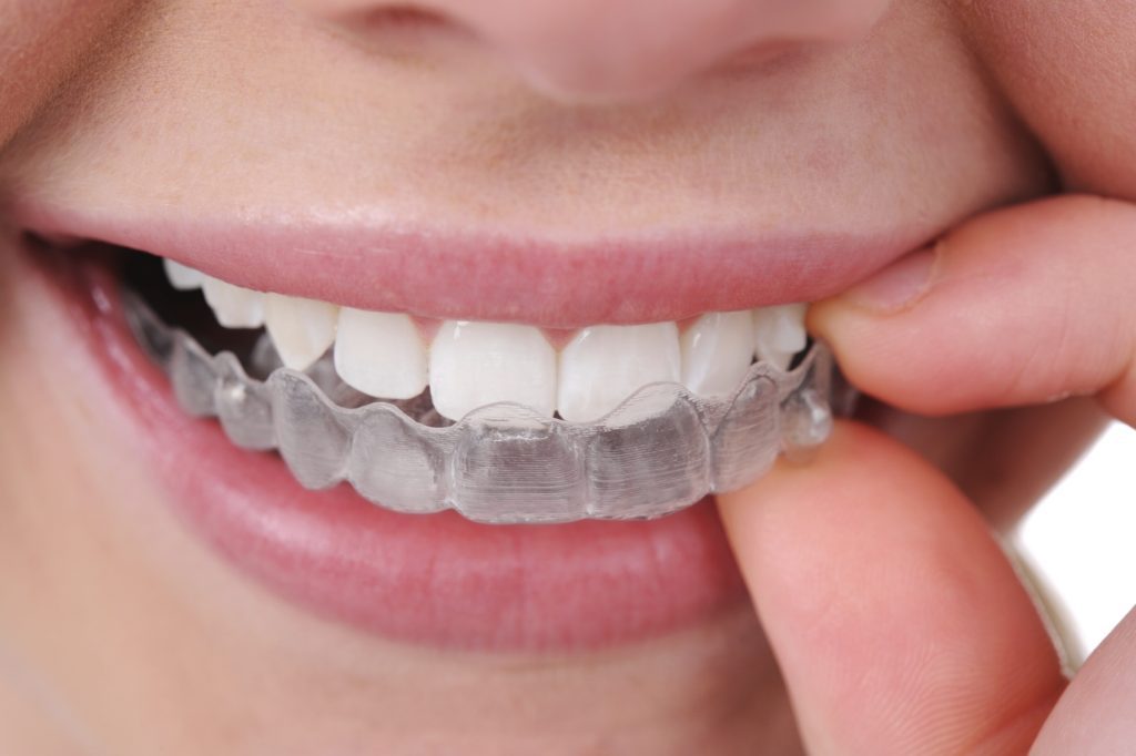 Invisalign Spring, TX - Best Dental