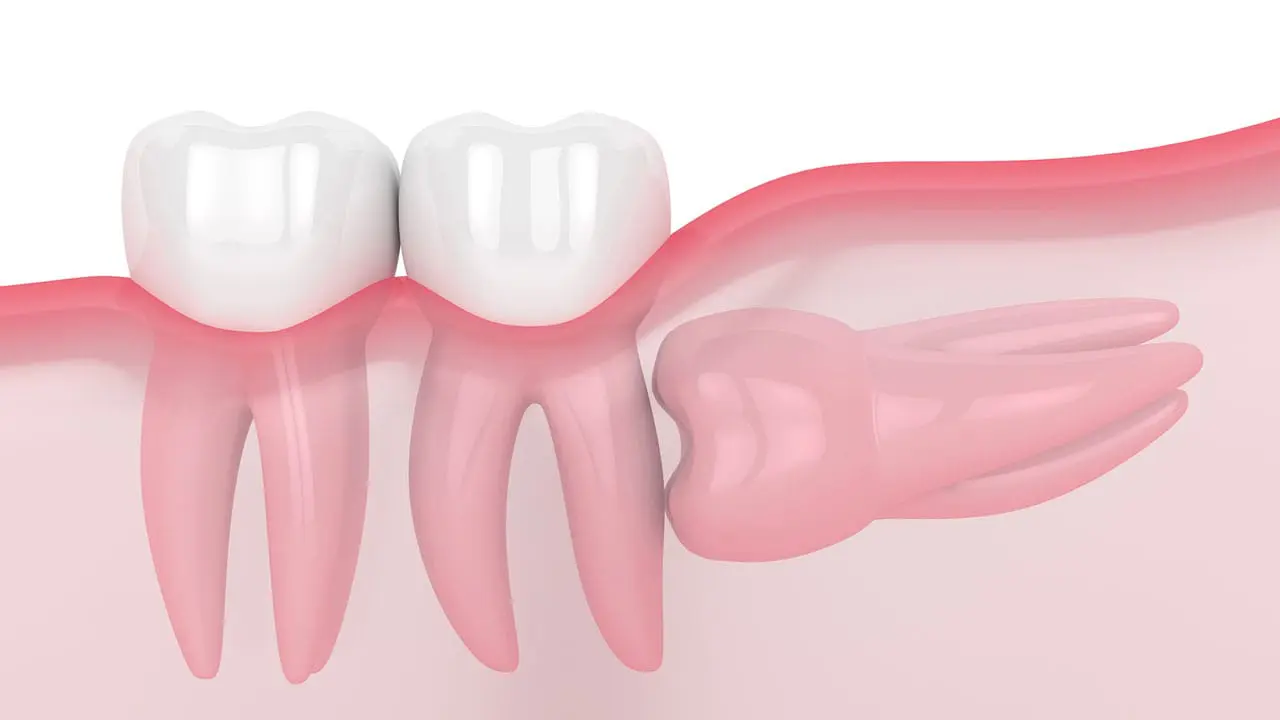 Does Your Wisdom Tooth Have A Sharp Edge? - Best Dental
