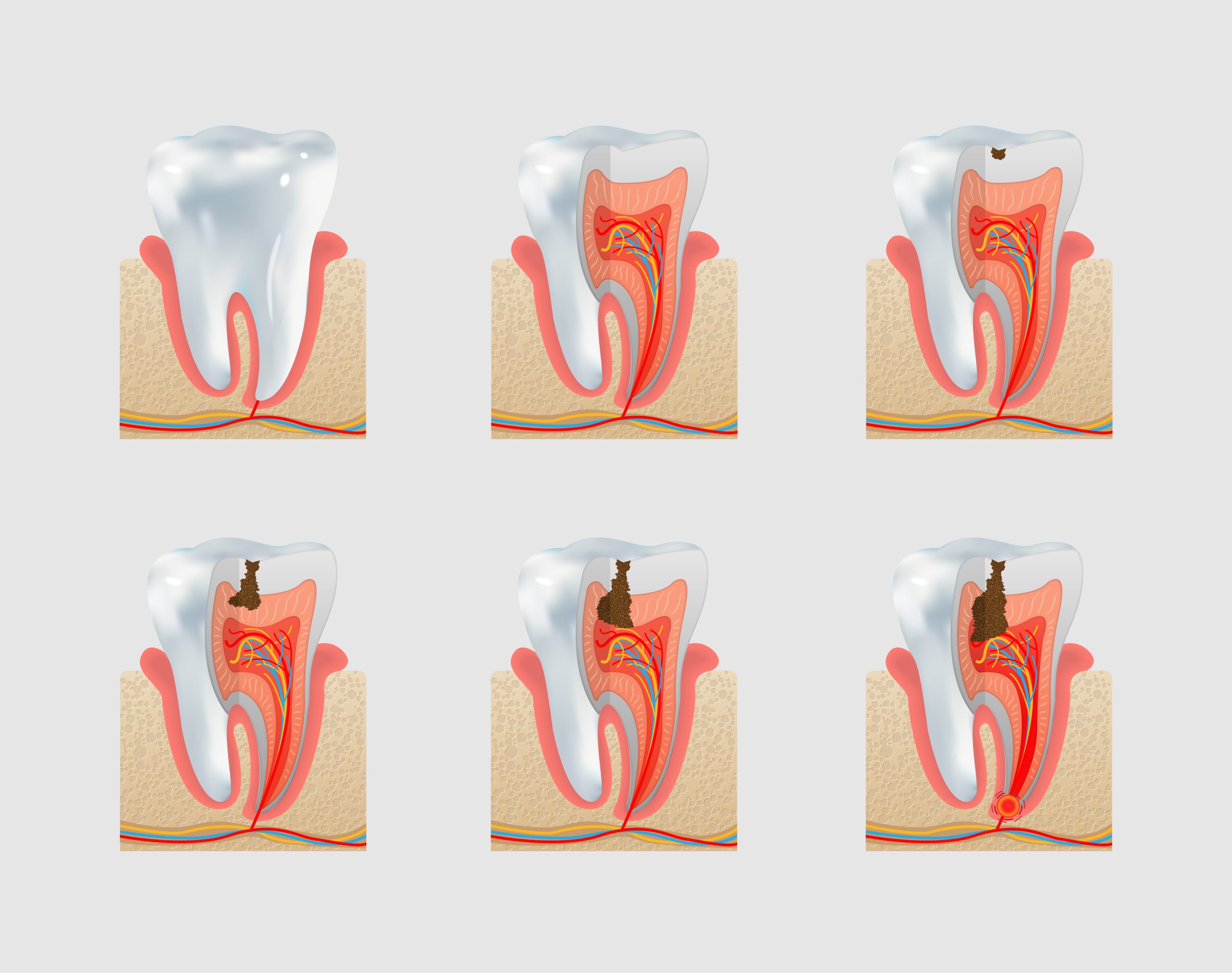 Root Canal Vs Tooth Extraction - Best Dental