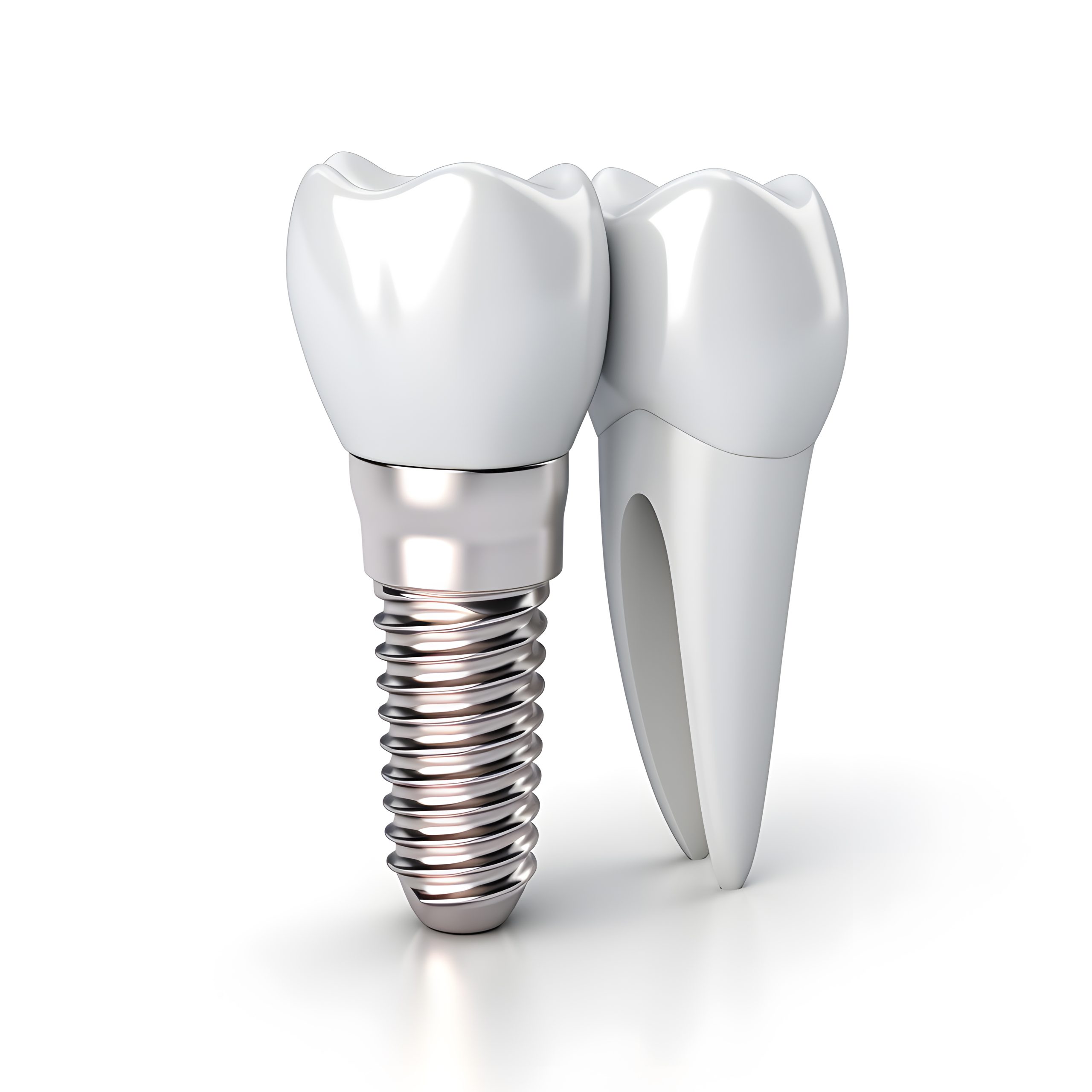 Dental Bridge VS Implant - A Complete Guide