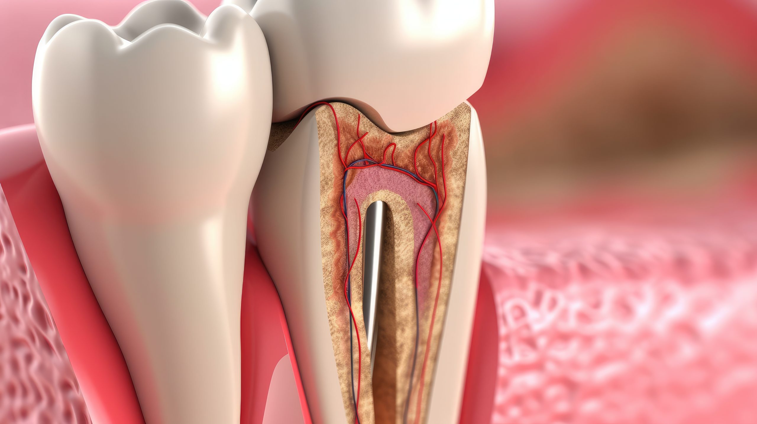 Root Canal Cost Without Insurance - Best Dental
