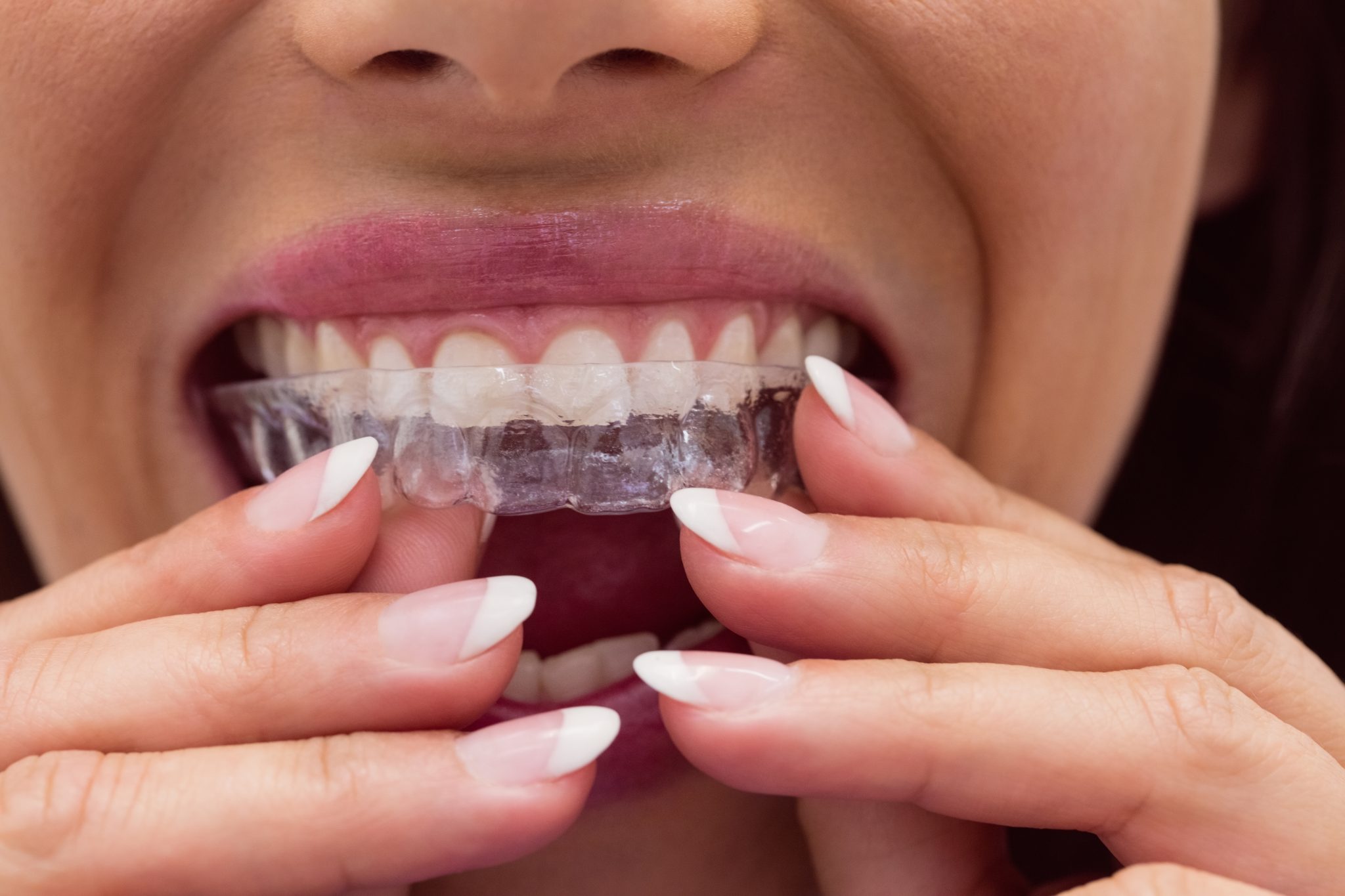 How To Fix Crooked Teeth - A Complete Guide - Best Dental