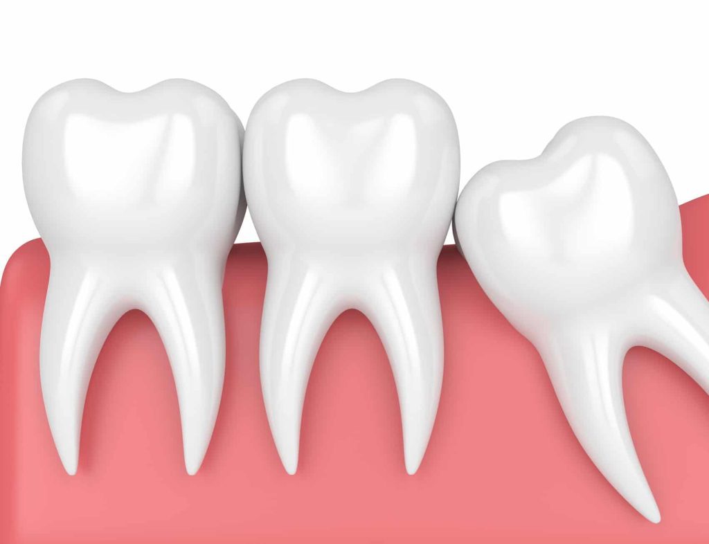 Wisdom Tooth Decay Treatment - Best Dental