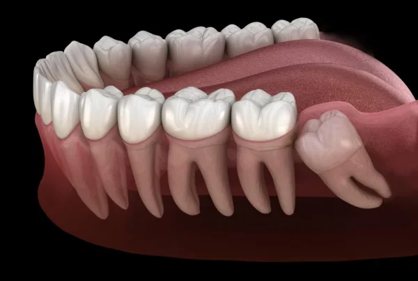 Why Your Wisdom Tooth Smells And How To Remedy It - Best Dental