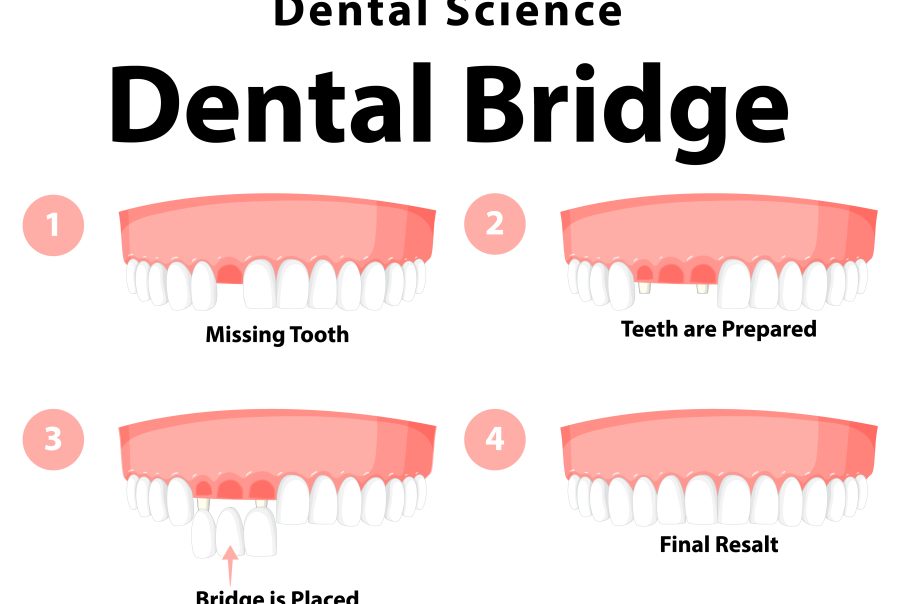 Infection Under A Dental Bridge - Causes, Symptoms, And Treatment ...