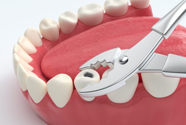 Supernumerary Wisdom Teeth - A Comprehensive Guide - Best Dental
