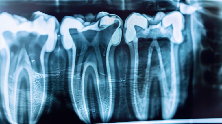 The Complete Guide to Root Canal and Crown Costs