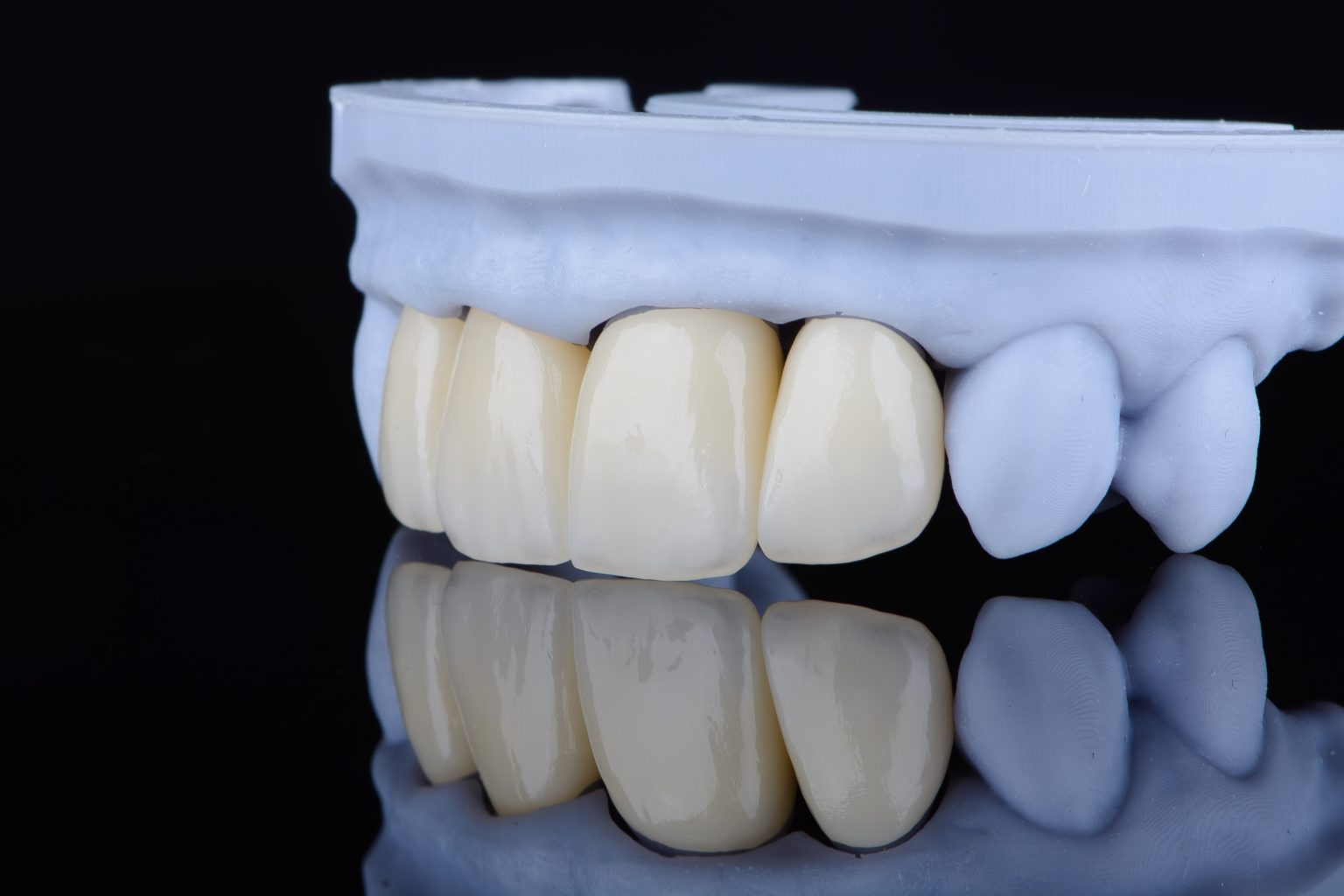 What Does Dental Bridge Treatment Entail? - Best Dental