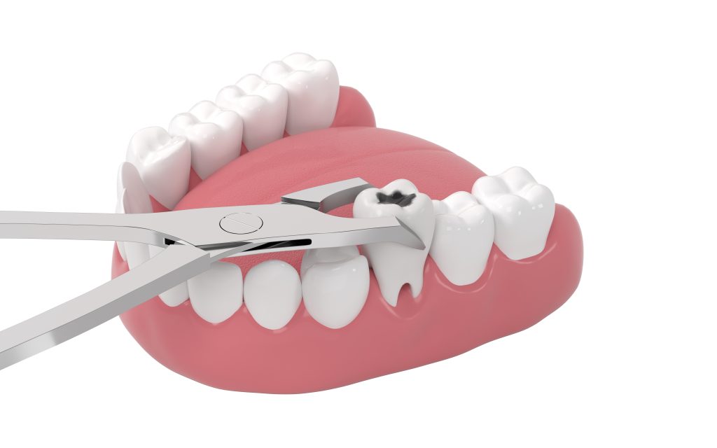 How Painful is a Tooth Extraction? - Best Dental